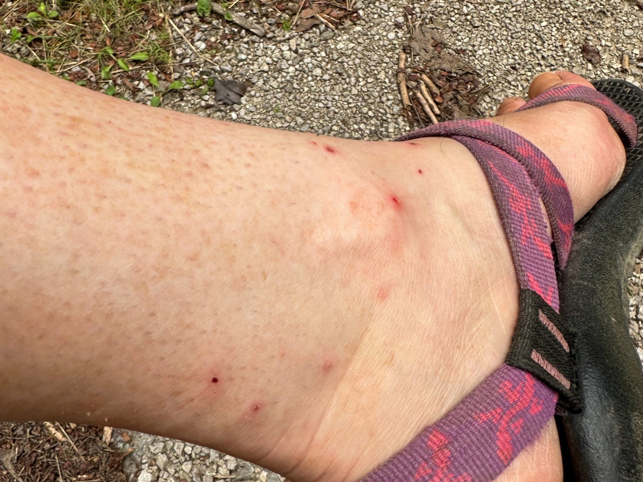 How to Treat Chigger Bites | Field & Stream